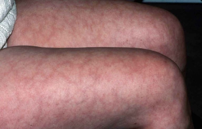 10 Warning Sign Poor Blood Poor Circulation in Legs Pictures with ...