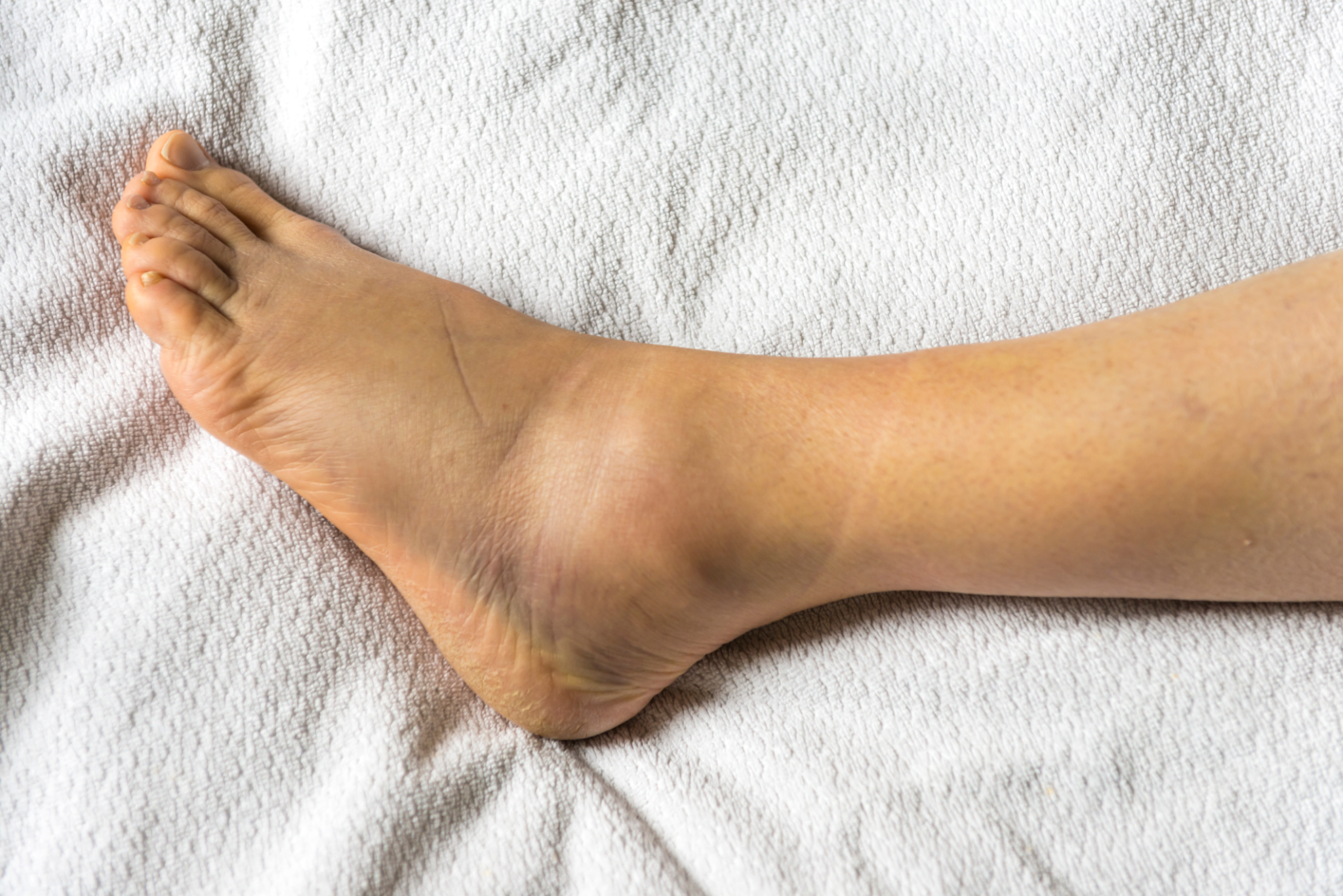 10 Warning Sign Poor Blood Poor Circulation in Legs Pictures with ...